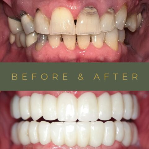 Implant Dentistry and Full Mouth Reconstruction